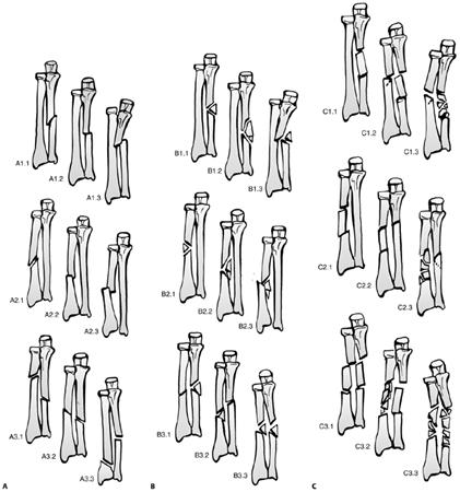 radius-and-ulnar-shaft-fractures-trauma-orthobullets